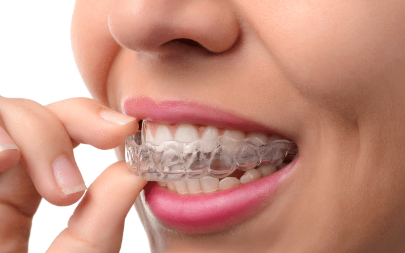 What To Expect During Your First Week With Invisalign? - River Family ...